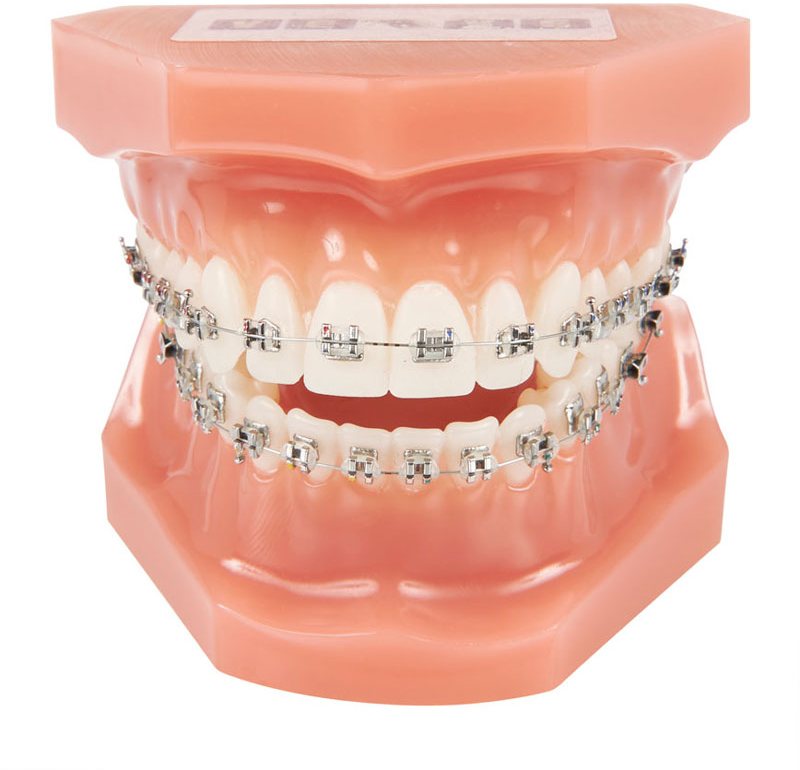 Verve Typodont - Consultation Models - TOC Dental
