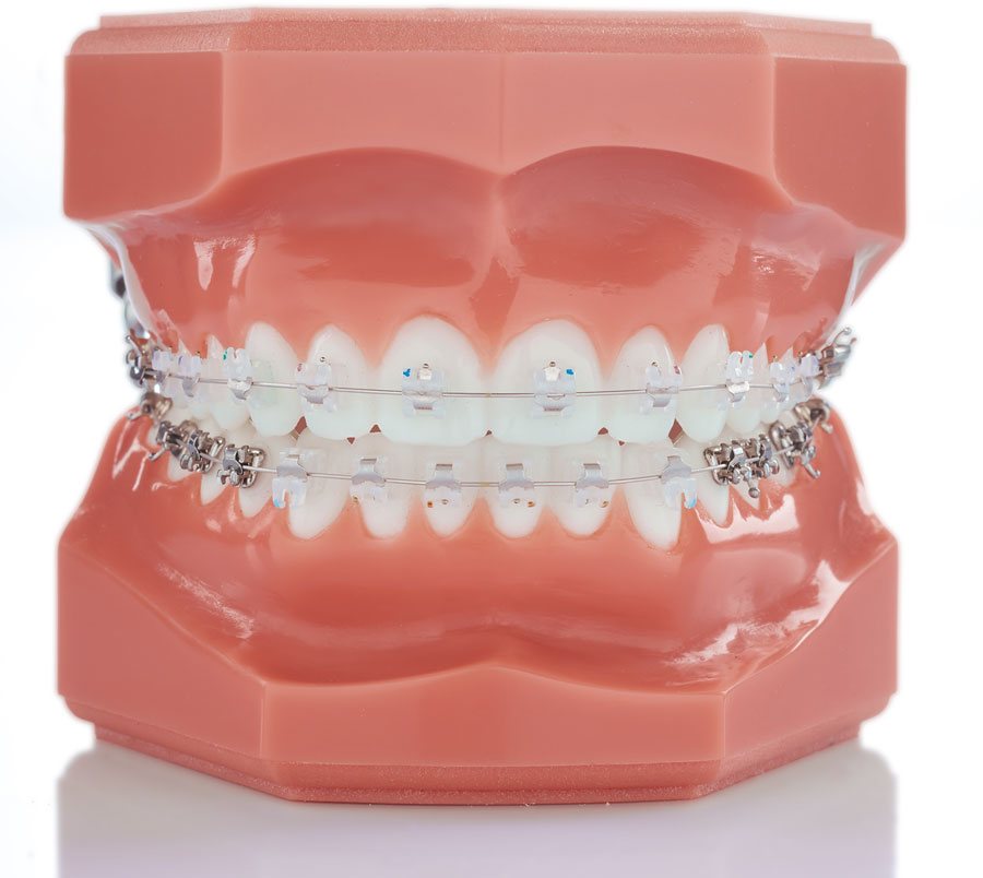 Experience C - Aesthetic Bracket Systems - TOC Dental