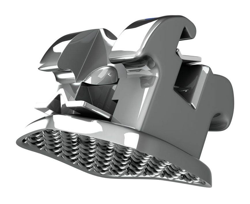 Experience Metal - Metal Bracket Systems - TOC Dental