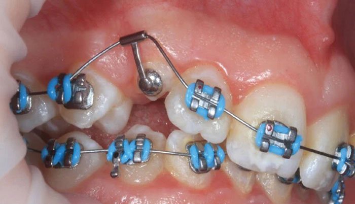 Esmail Eruptor - Bondable Attachments - TOC Dental