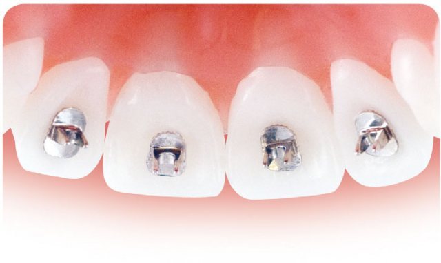 Tongue Tamers - Bondable Attachments - TOC Dental