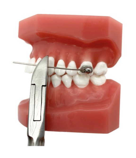D2 Distalizing Appliance - Class II Corrector - TOC Dental