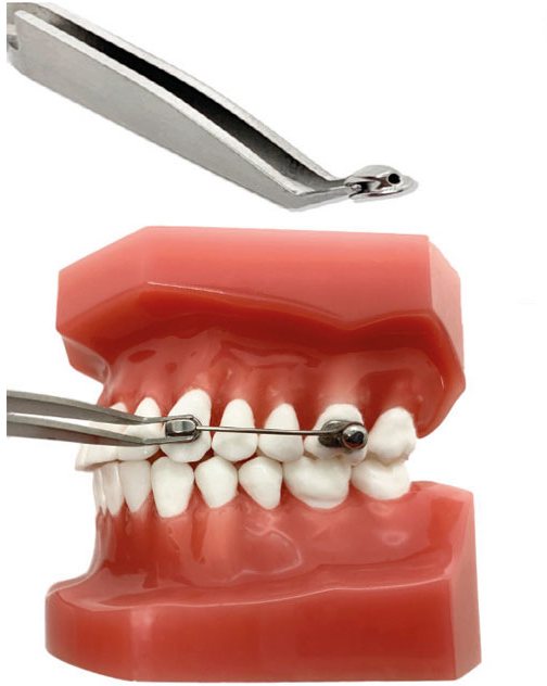 D2 Appliance - Class II Corrector - TOC Dental