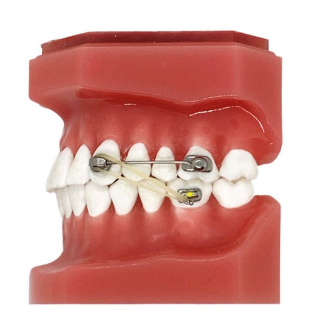 D2 Appliance - Class II Corrector - TOC Dental