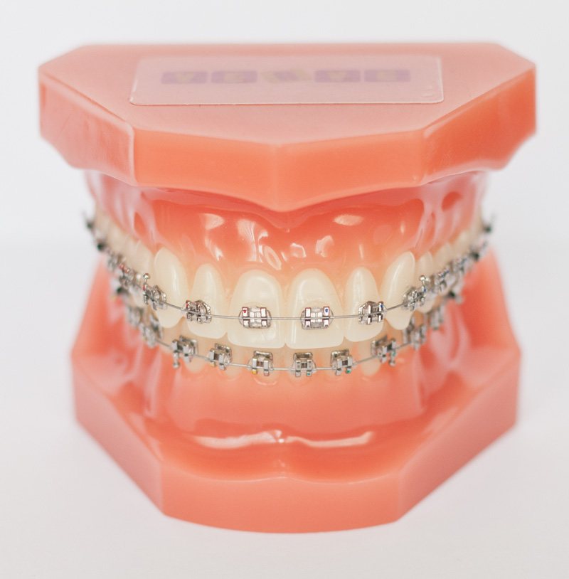 Verve Bracket Kits - Metal Bracket Systems - TOC Dental