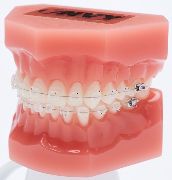 Envy Composite Bracket Kit - Aesthetic Bracket Systems - TOC Dental