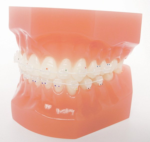 Verve Ceramic Bracket Kit - Aesthetic Bracket Systems - TOC Dental