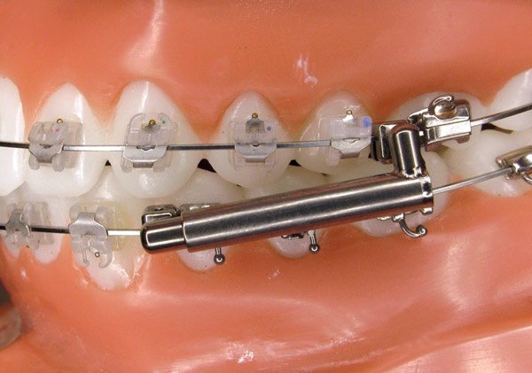 Bio Bite Corrector MS - Class II Corrector - TOC Dental