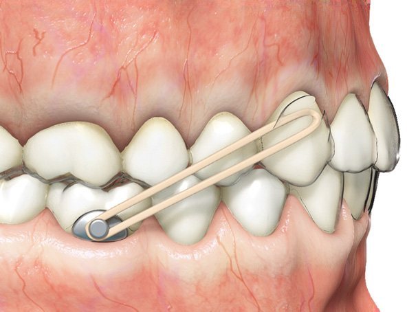Precision Aligner Buttons - Bondable Attachments - TOC Dental