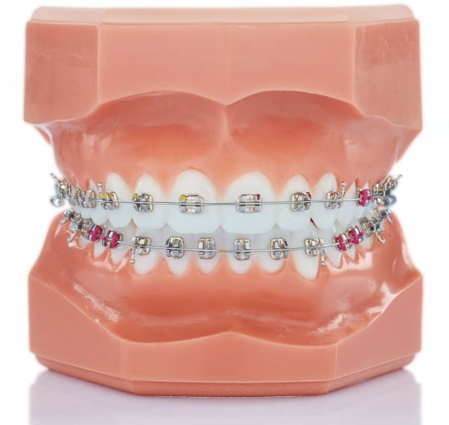 Legend Medium Brackets - Metal Bracket Systems - TOC Dental