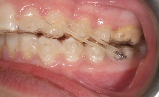 Aligner Hook - Stops & Hooks - TOC Dental