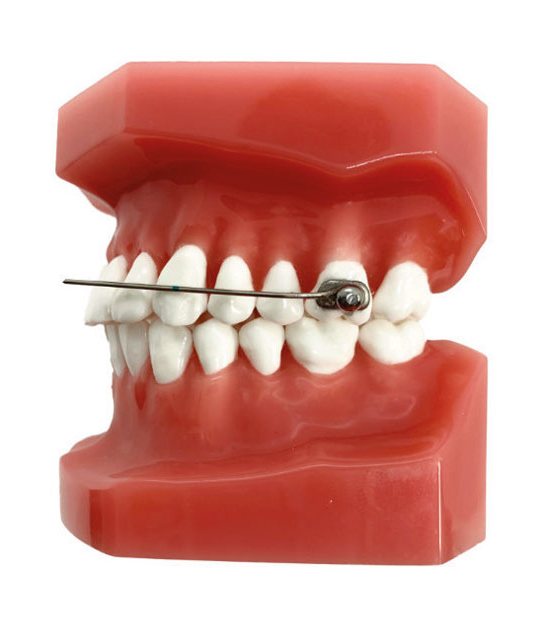 D2 Appliance - Class II Corrector - TOC Dental