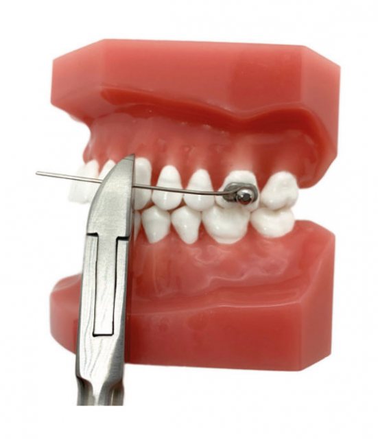 D2 Appliance - Class II Corrector - TOC Dental