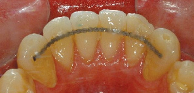 Ortho FlexTech - Lingual Wires - TOC Dental