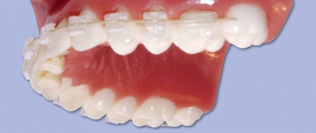 BiteBumper - Bondable Attachments - TOC Dental