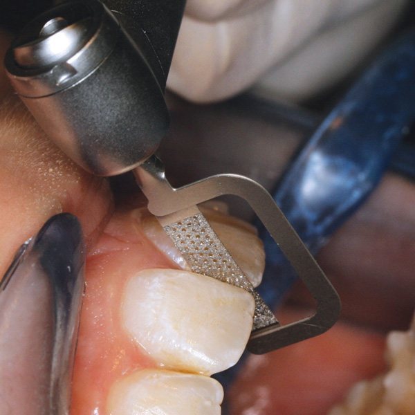 Swingle Ortho Professional Kit - IPR Kits - TOC Dental