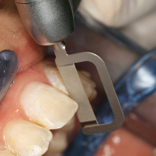 Swingle Ortho Professional Kit - IPR Kits - TOC Dental