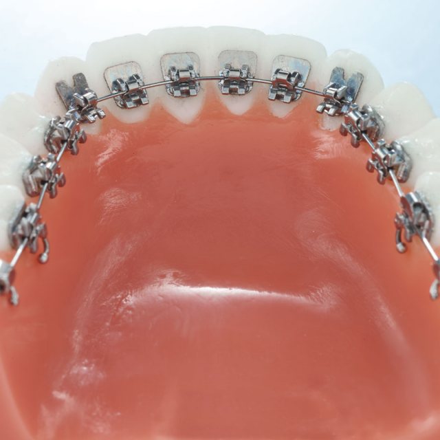 Experience L Bracket Kits - Lingual Brackets - TOC Dental
